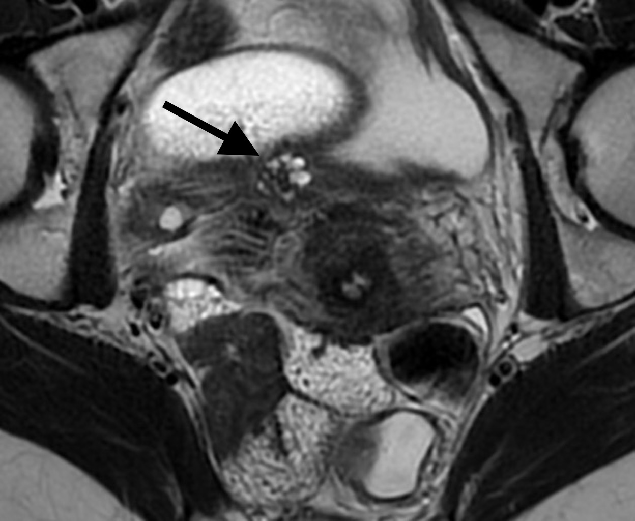 IRM pelvienne et endométriose : Tout ce qu’il faut savoir sur cet ...