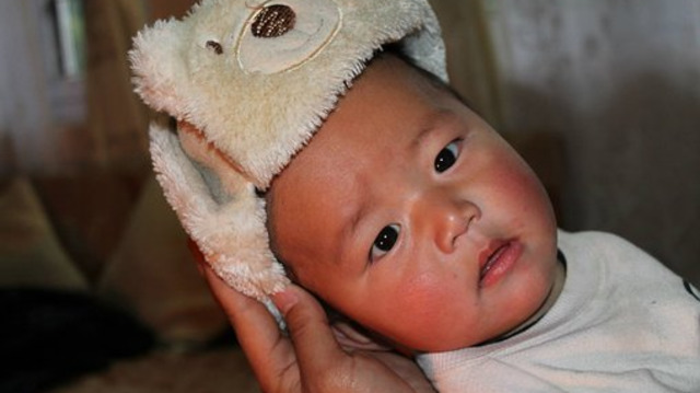 Ictère néonatal : Une règle précise et peu coûteuse aide au dépistage ...